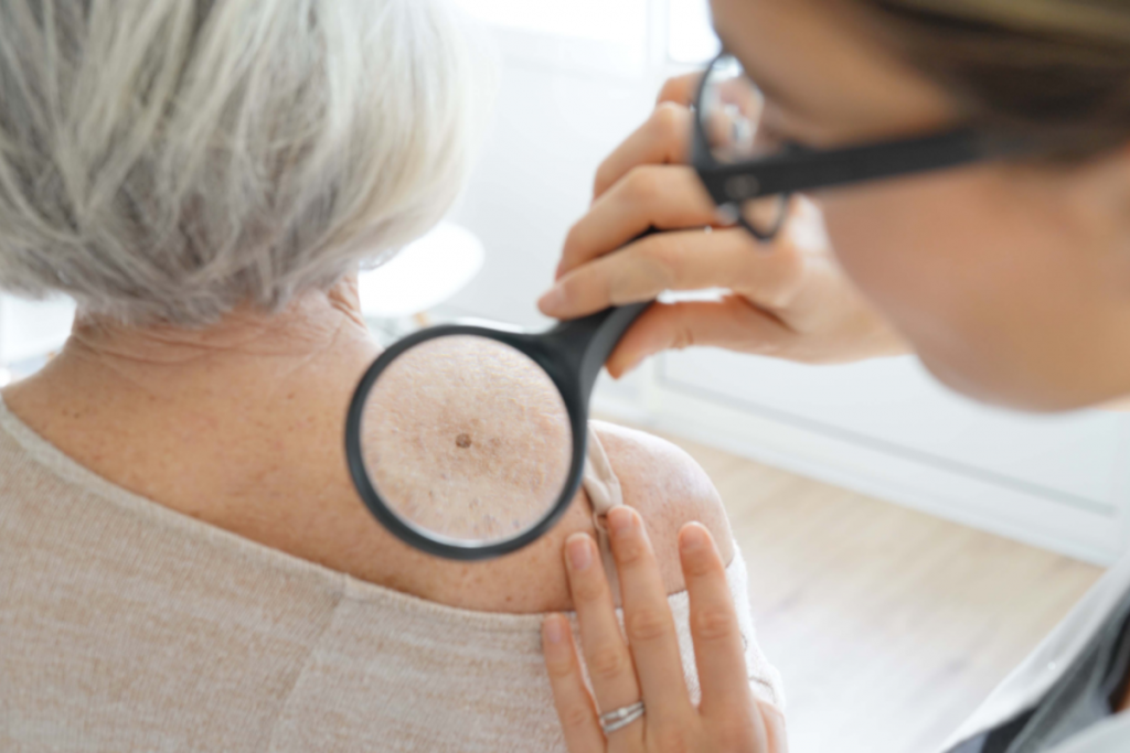Skin Cancer Prevention: Heightening Awareness – René Serbon