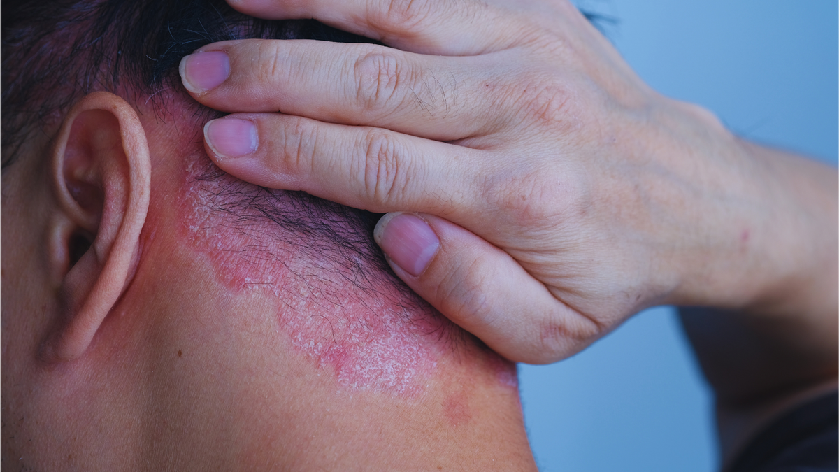Psoriasis Awareness Month: A Professional's Guide to Assessment and Su ...